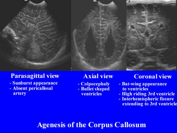 Variations in Nervous System | Anatomical Variations and Anomalies ...