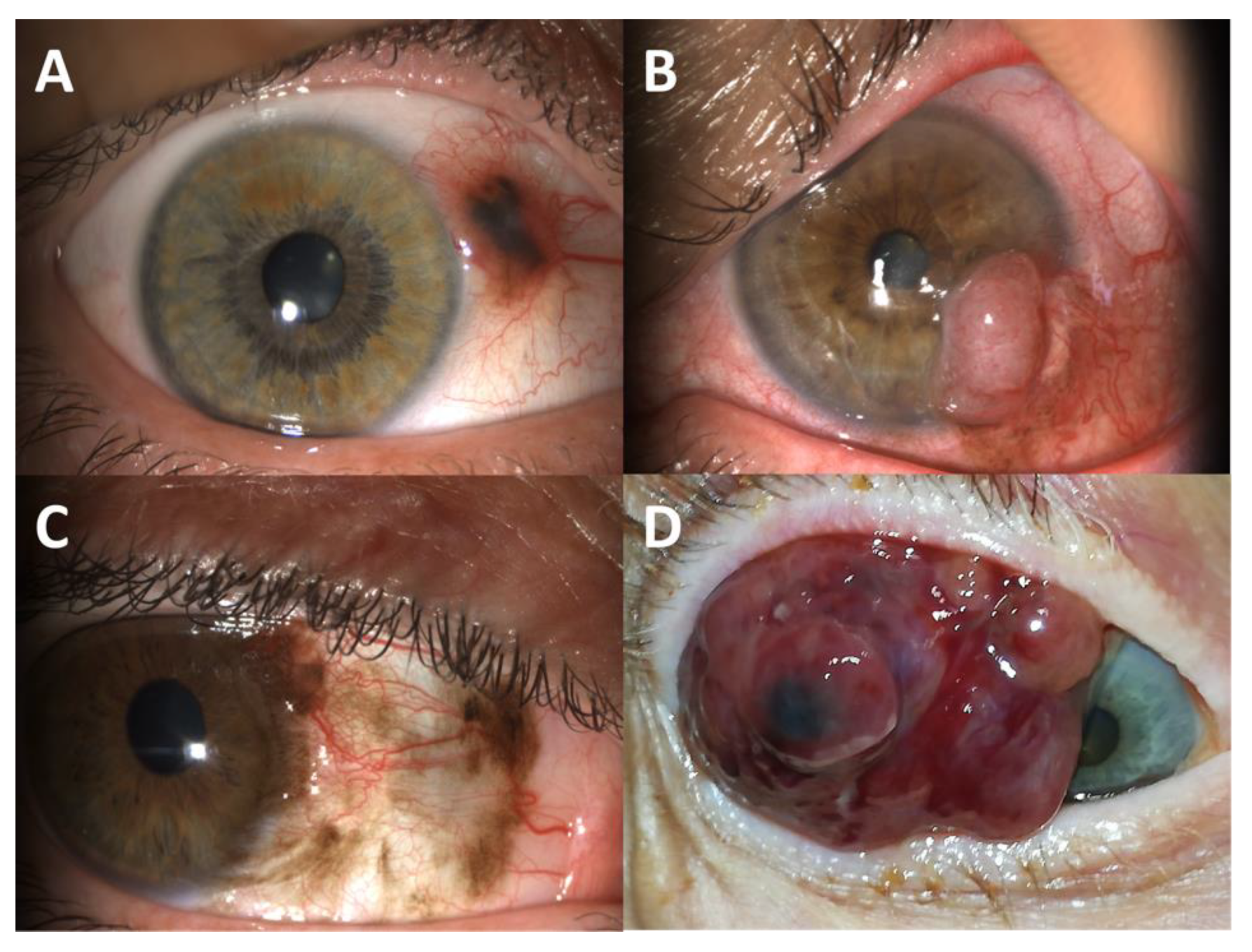 Malignant Tumors of Conjunctiva | Diseases of the Conjunctiva ...